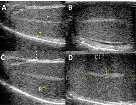 Grey B Mode Ultrasonograms Showed The Echogenic Mediastinum Thickness
