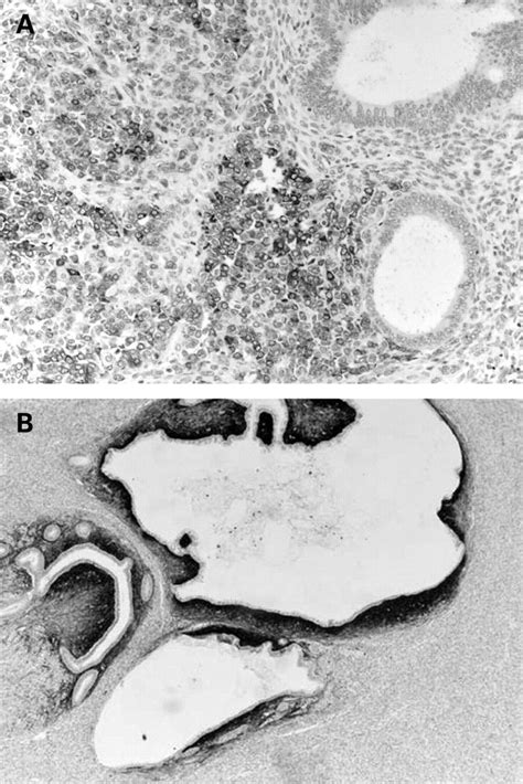 Uterine Adenosarcomas Overgrown By Sex Cord Like Tumour Report Of Two