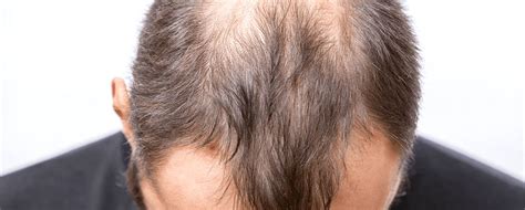 5 Most Common Reasons For Hair Loss In Men Limmer Hair Transplant Center