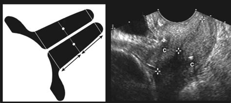 Ultrasound Evaluation Of The Gravid Cervix Radiology Key