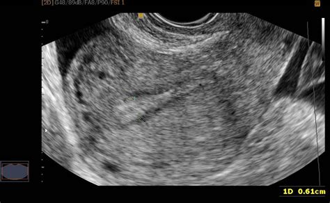 Ectopic Pregnancy Image