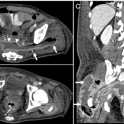 The Contrast Enhanced Abdominal Computed Tomography Ct Images In