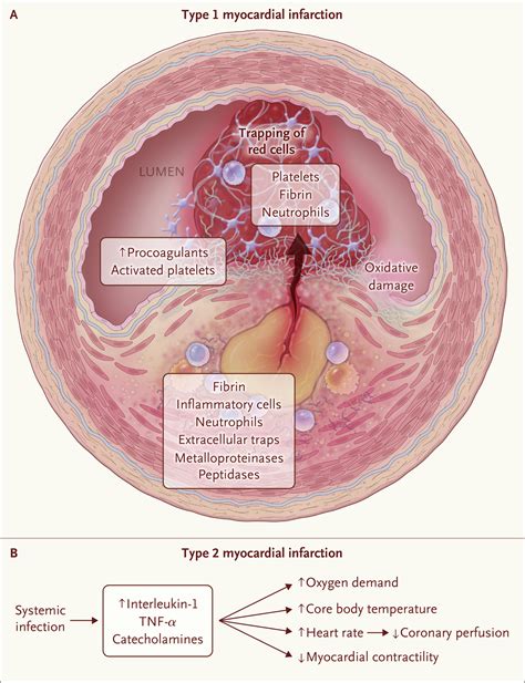 Acute Infection And Myocardial Infarction Nejm