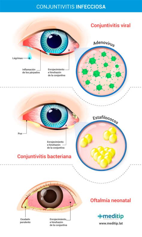 Tratamiento De La Conjuntivitis Identifica Los Síntomas Que Requieren