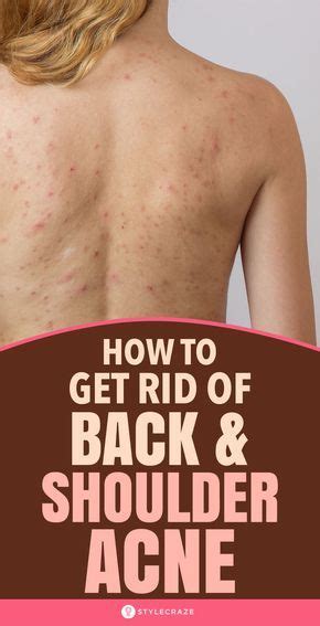 How To Get Rid Of Back Acne Using Home Remedies Artofit