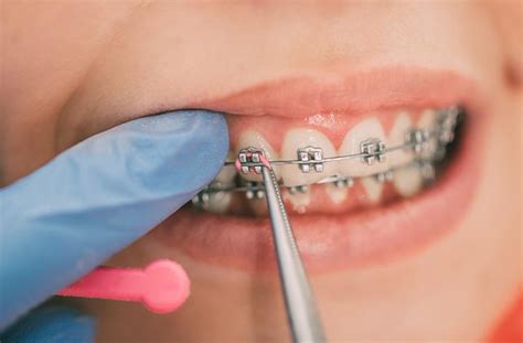 Traditional Braces Lawrence Ma Pediatric Orthodontics Orthodontist