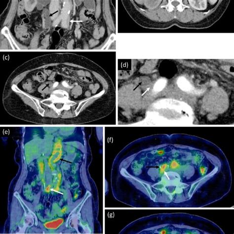 Figure1 Initial Contrast Enhanced Computed Tomography Scan After