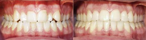 What Is Overbite Underbite Openbite Crossbite In Orthodontics