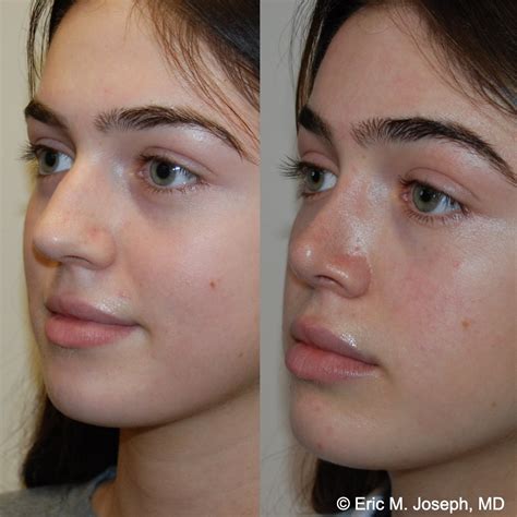 Eric M Joseph Md Rhinoplasty Before And After A Narrower Nasal