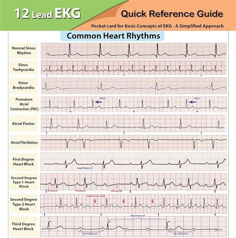 How To Read An Ekg Informacionpublica Svet Gob Gt
