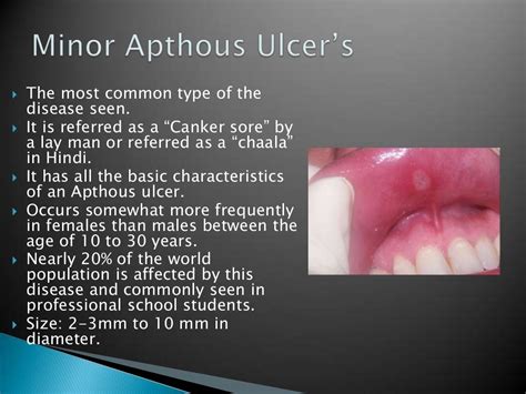 Management And Treatment Of Recurrent Apthous Ulcers