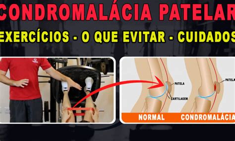 Condromalácia Patelar O Que é Exercícios E Tratamento Treino Mestre