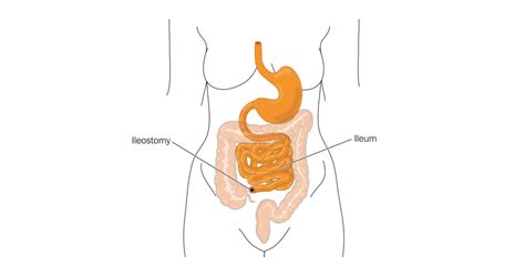 Ileostomy Reversing A Temporary Ileostomy