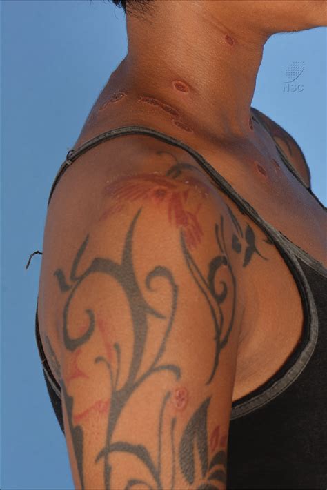 Targetoid Bullous Tinea Corporis Unusual Presentation Of A