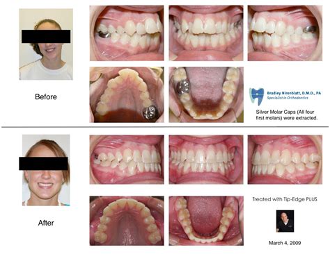 Braces