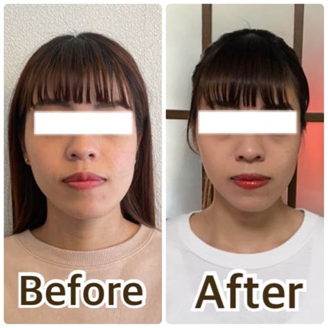 たった1回の施術で歪みとエラ張りを解消して顎がシュッとなりました〜 三重県松阪市小顔専門サロンnagomi♡
