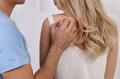 Doctor Dermatologist Examines Birthmark Of Patient Checking Benign