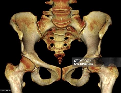 Ct Scan Of Pelvic Bone With Both Hip Joint 3d Rendering Image High Res