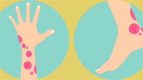 Psoriasis Síntomas Causas Y Tratamiento
