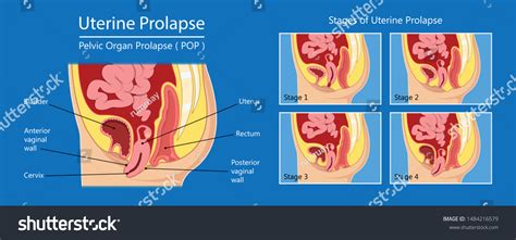 Pelvic Floor Prolapse Type Uterine Uterus 库存矢量图（免版税）1484216579