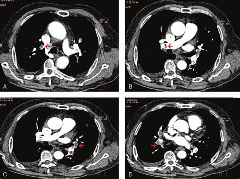 Computed Tomography Image Showing Pulmonary Embolism Red Arrows A D