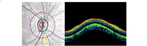 Optical Coherence Tomography Image Showing Peripapillary Retinal Nerve