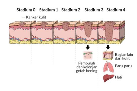 Kanker Kulit Melanoma Gejala Penyebab Dan Pengobatan Alodokter
