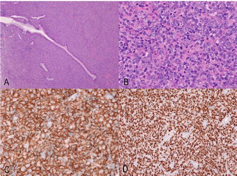 Diffuse Large B Cell Lymphoma Of The Cervix A Diffuse In Fi Ltration
