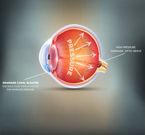 Ocular Hypertension And Glaucoma Fort Lauderdale Eye Institute