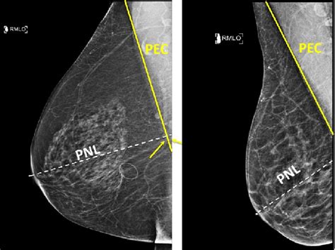 Example Of Adequately And Inadequately Positioned Mediolateral Oblique