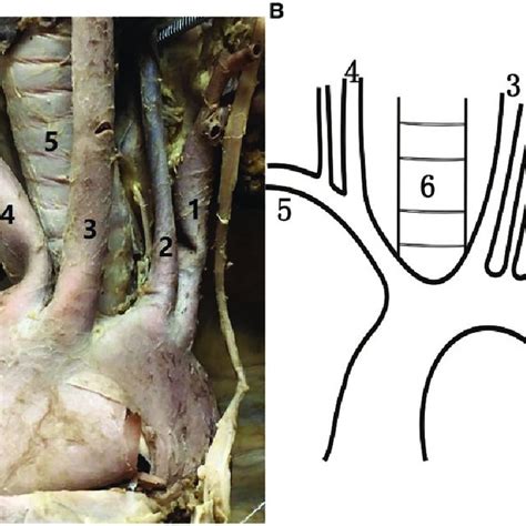 A The Most Common Anomalous Branching Of The Aortic Arch And The