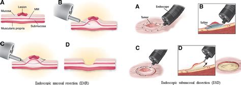 The Endoscopic Technical Aspects Of Endoscopic Rejection Left Panel