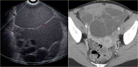 The Radiology Assistant Ovarian Cysts Common Lesions