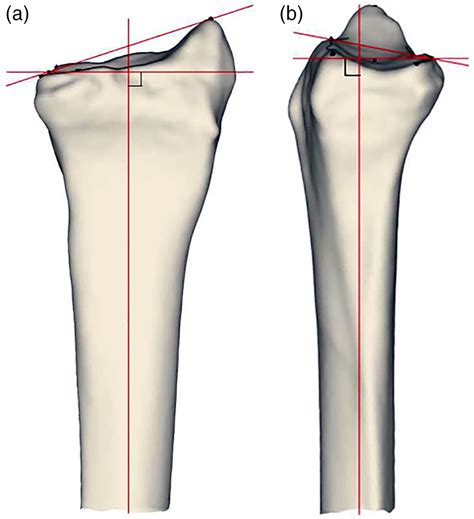 Computer‐aided 3d Analysis Of Anatomy And Radiographic Parameters Of