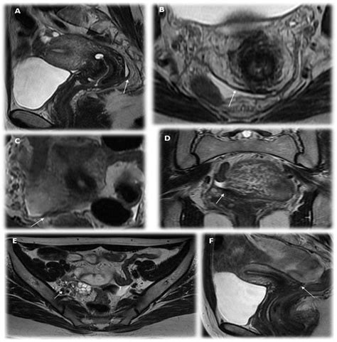Jcm Free Full Text Endometriosis In Adolescents Diagnostics
