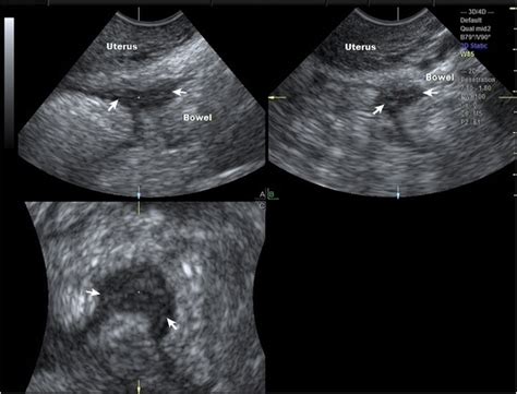 Applying A Statistical Method In Transvaginal Ultrasound Training