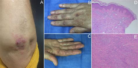 Palisaded Neutrophilic And Granulomatous Dermatitis Download