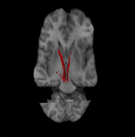 Nigrostriatal Pathway Wikiwand