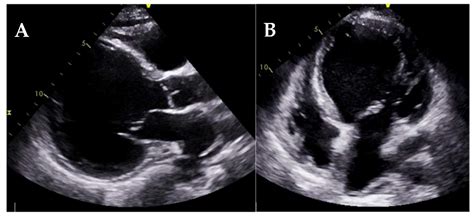 Dilated Cardiomyopathy Echo