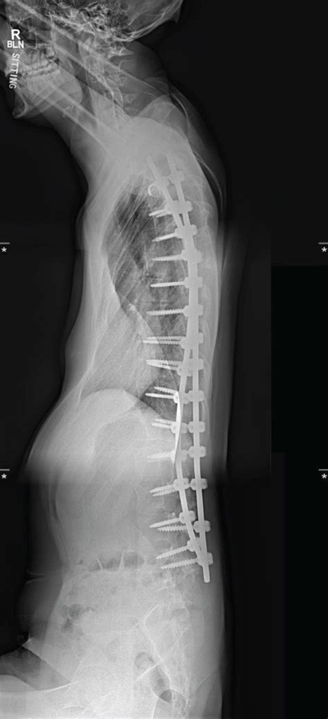 Preoperative And Postoperative Radiographs The Top Two Images Are The