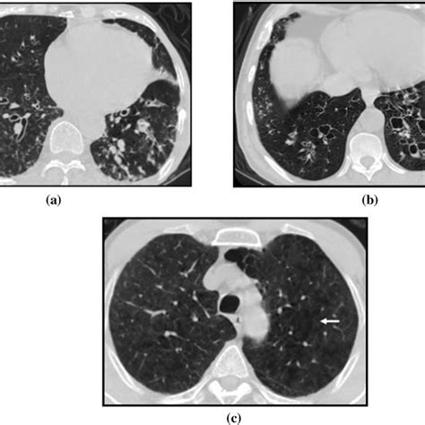 Quality Of Life Of Different Stages Of Copd And Bronchiectasis P1