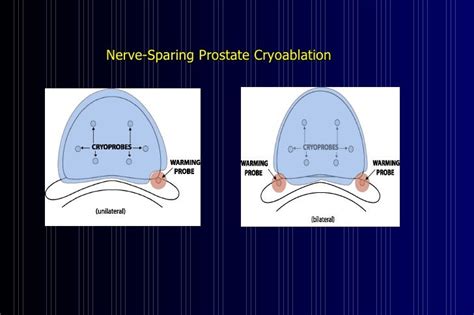 Prostate Cancer Causes Diagnosis And Treatment Options Bruce B …
