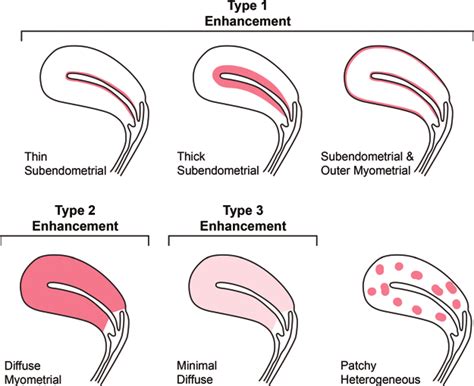 Schematic Shows The Patterns Of Uterine Enhancement That May Be Seen At