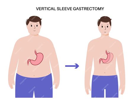 Premium Vector Vertical Sleeve Gastrectomy Laparoscopy Stomach