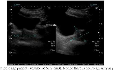 [pdf] Assessing Prostate Pathologies With Trans Abdominal Ultrasound