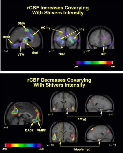 Neuroanatomical Regions Demonstrating Significant Rcbf Correlations