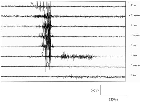 Overview Of The Application Of Emg Recording In The Diagnosis And
