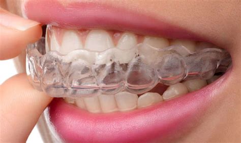 Invisalign Cost Alternatives And Comparison Dentistry