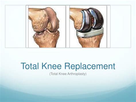 Ppt Total Knee Replacement Powerpoint Presentation Free Download
