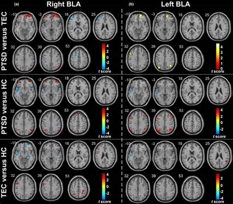 Group Differences In Bla Resting‐state Functional Connectivity Maps